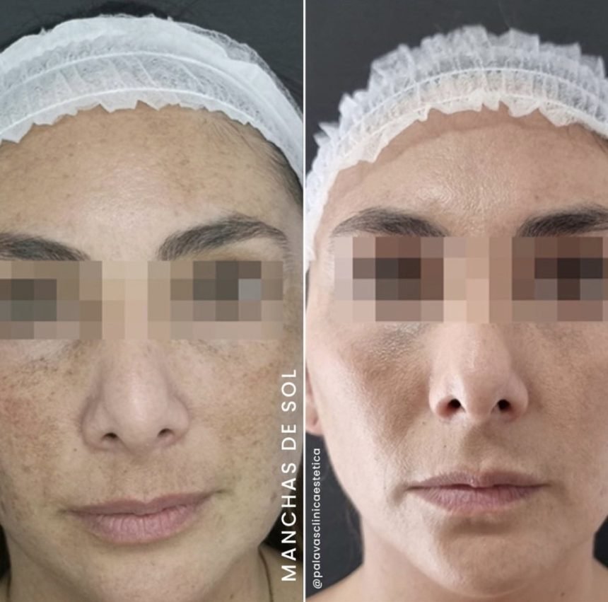 Manchas de Sol - Palavas Clinica Estetica