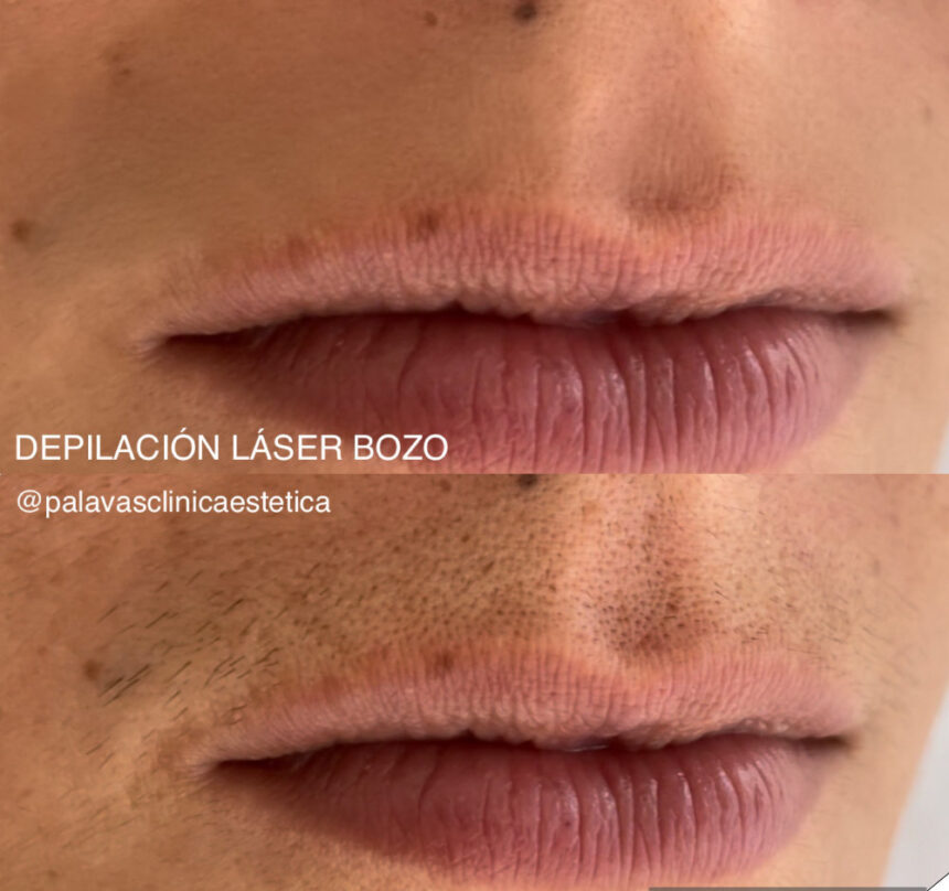 DEPILACIÓN LÁSER Resultados - Palavas Clinica Estetica